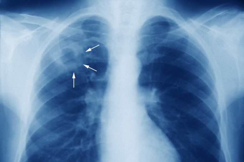 Tuberculosis, prevenible y curable