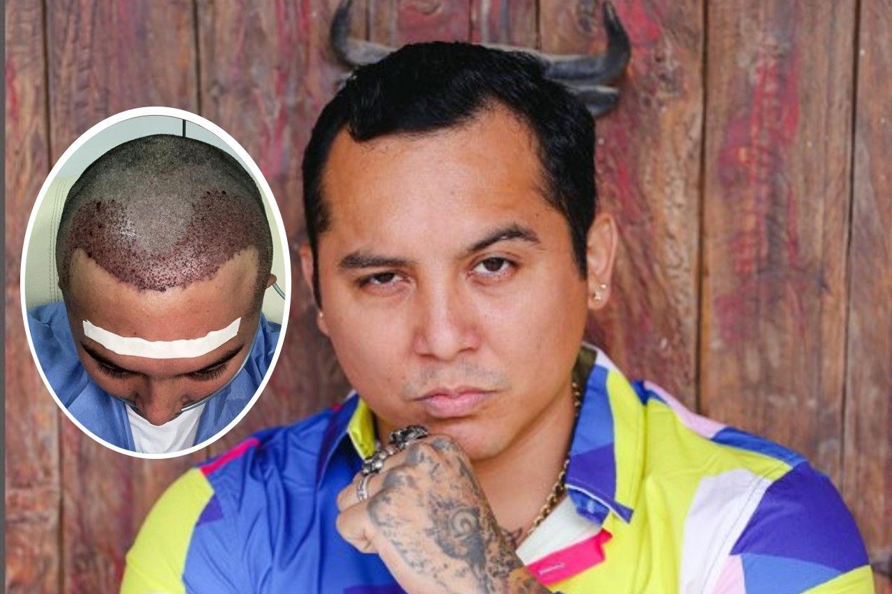 Edwin Luna no soporta la calvicie y se somete a injerto capilar