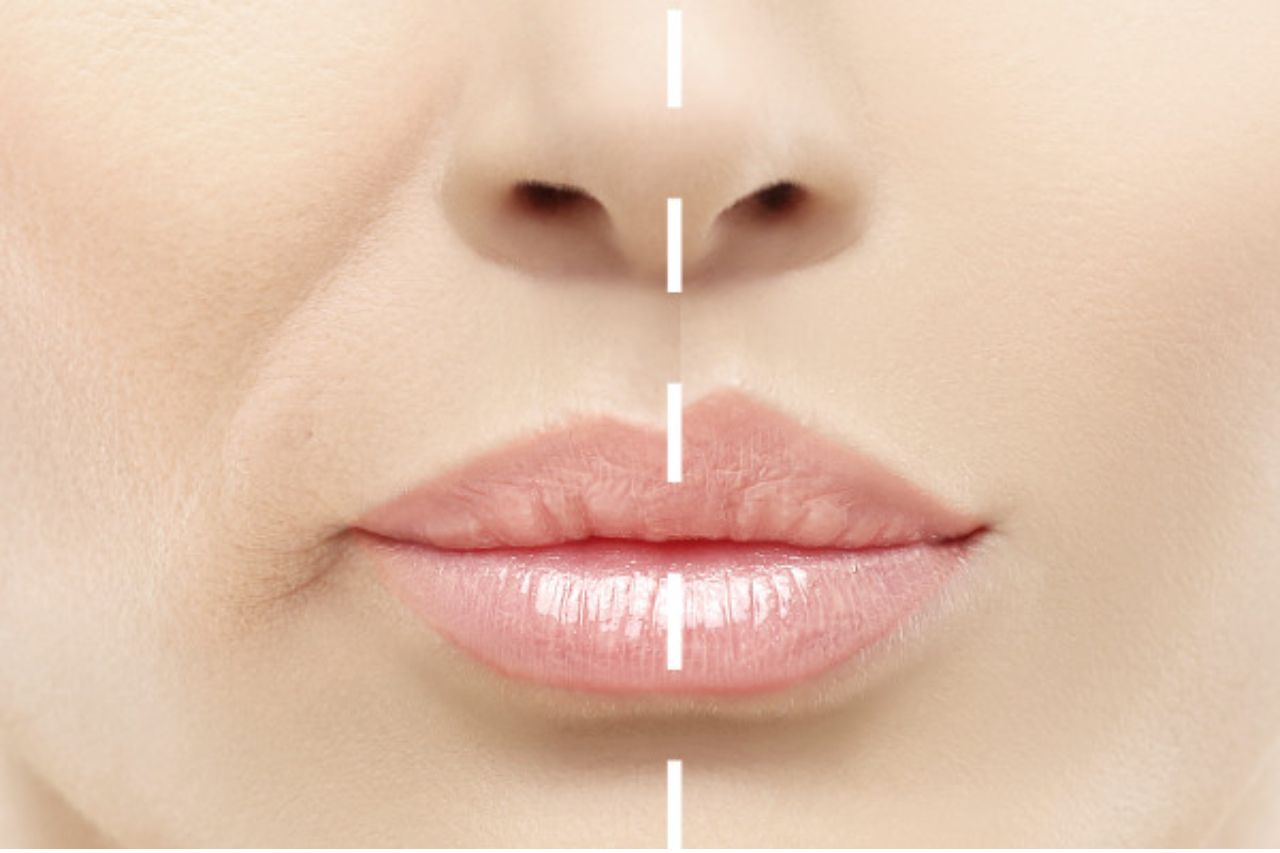 Qué es es surco nasogeniano y cómo eliminarlo