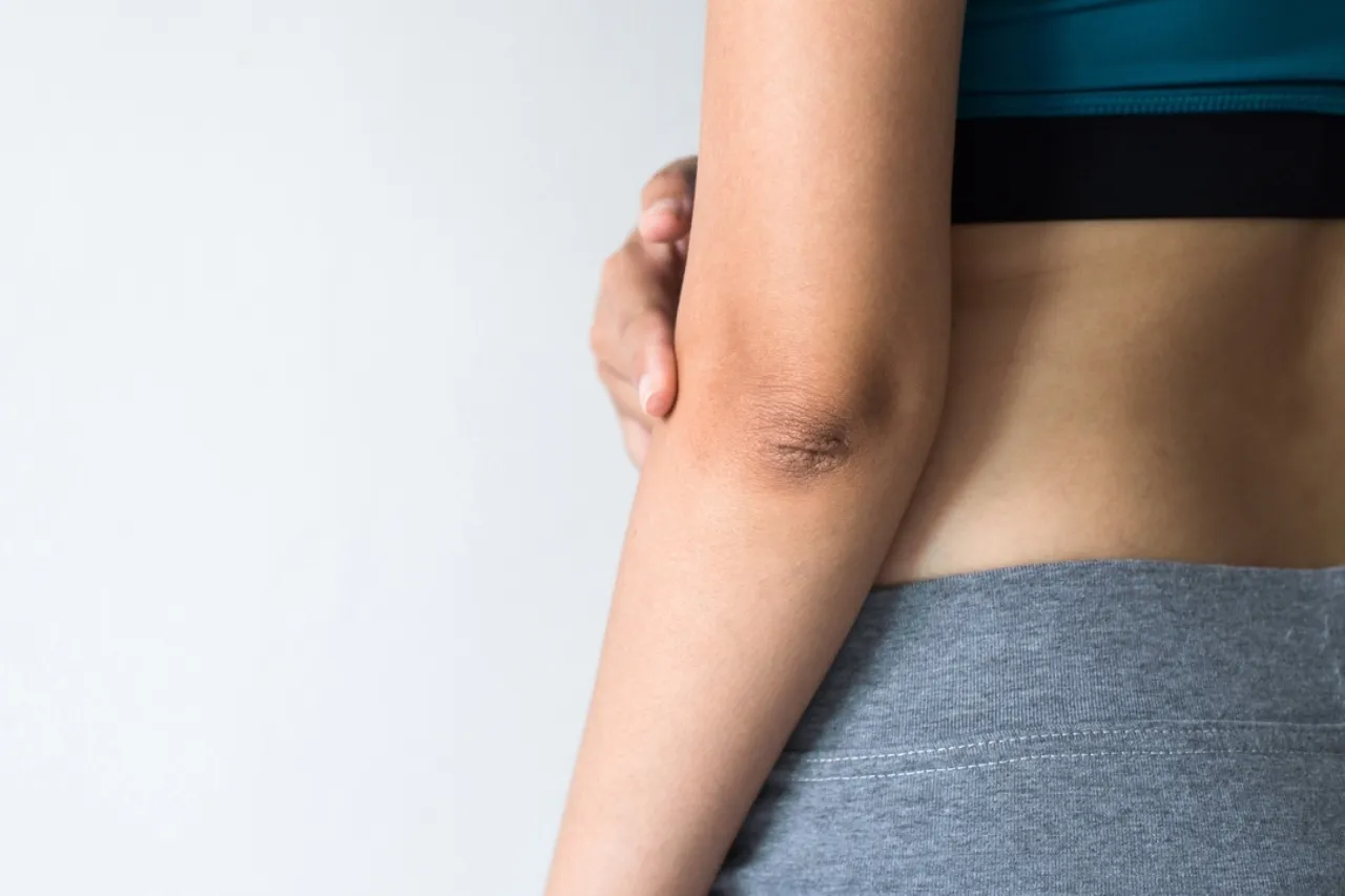 ¿Codos negros? Por qué aparecen y cómo solucionarlo